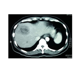 Liver abscess | PPTX