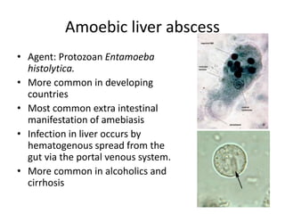 Liver abscess | PPT
