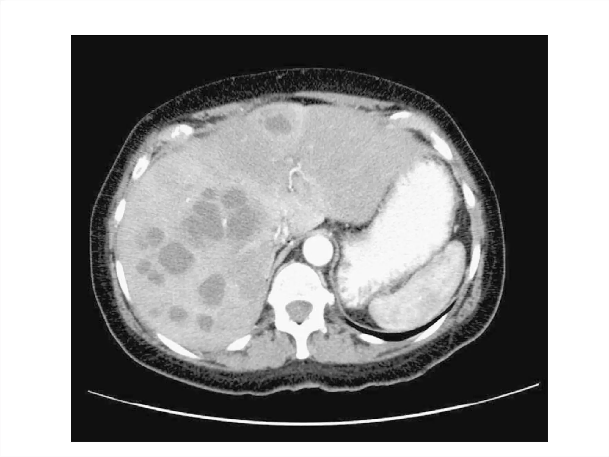 LIVER ABSCESS-1_withMarginNotes.pdf