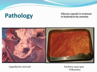Anchovy Sauce Liver Abscess