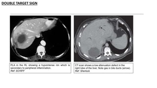 Liver abscess | PPTX