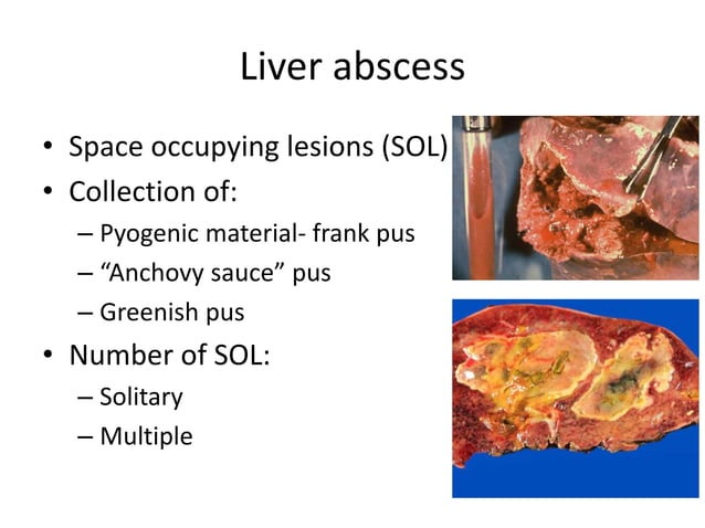 Liver abscess | PPT
