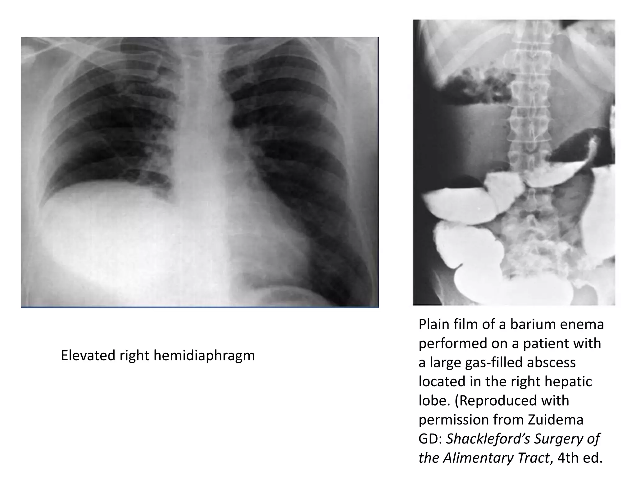 LIVER ABSCESS.pptx