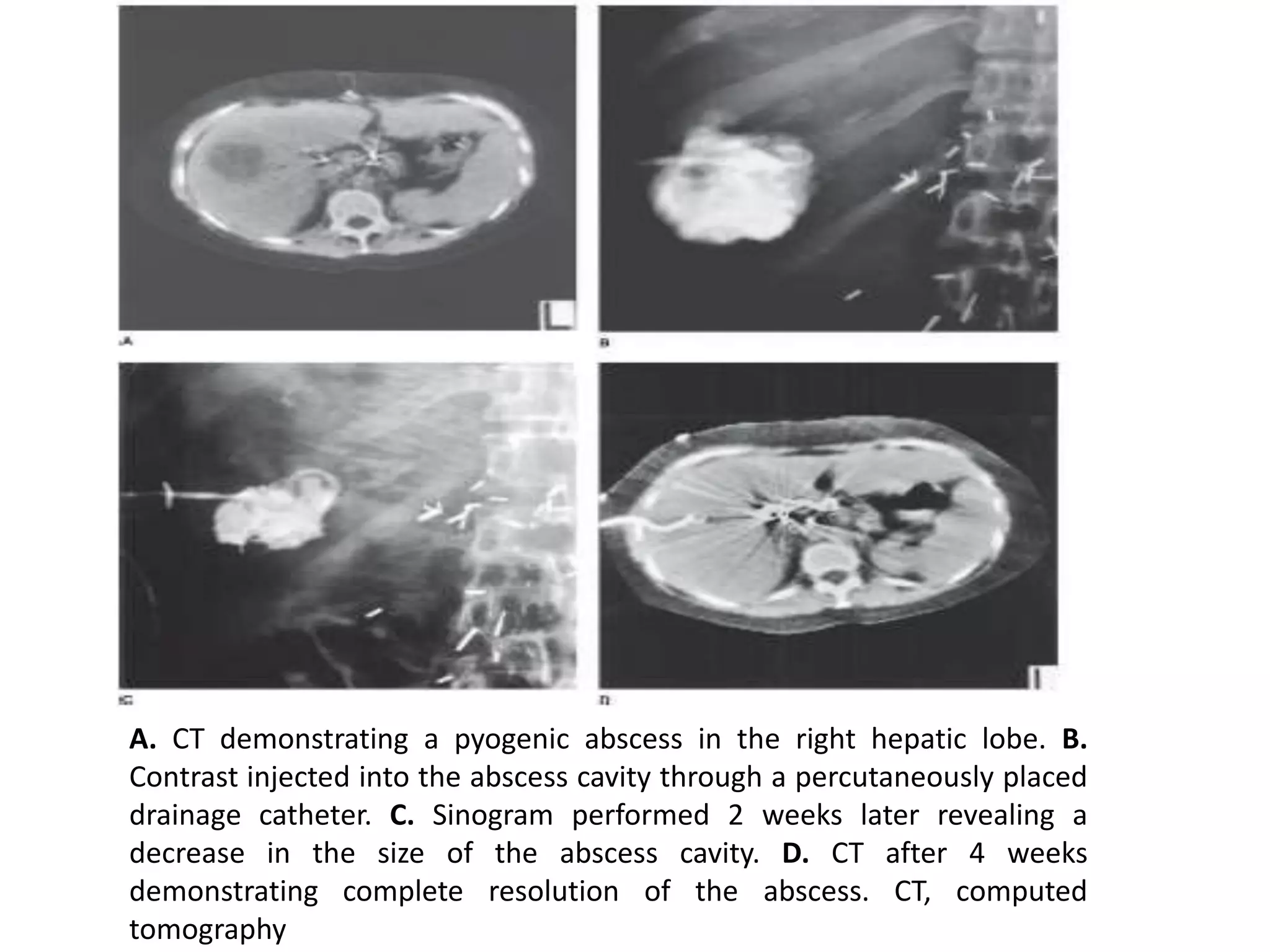 LIVER ABSCESS.pptx