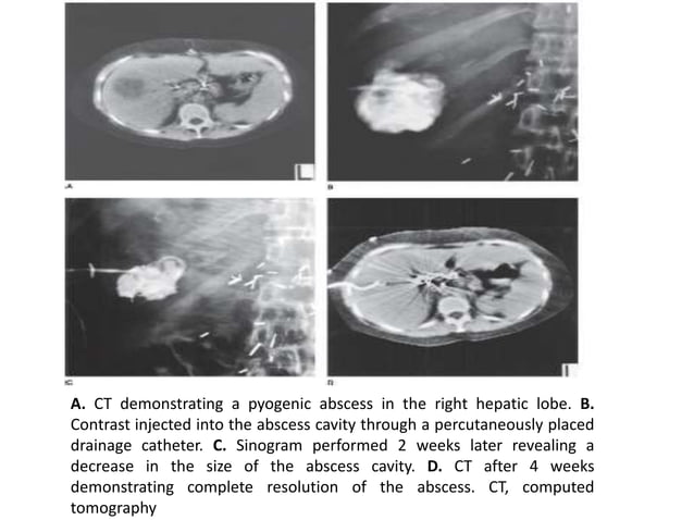 LIVER ABSCESS.pptx