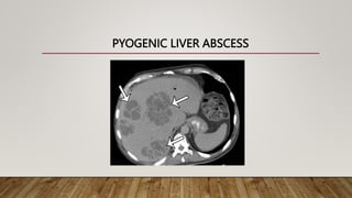 LIVER ABSCESS.pptx