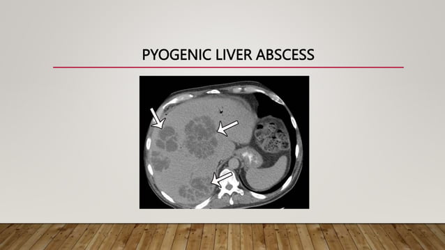 LIVER ABSCESS.pptx