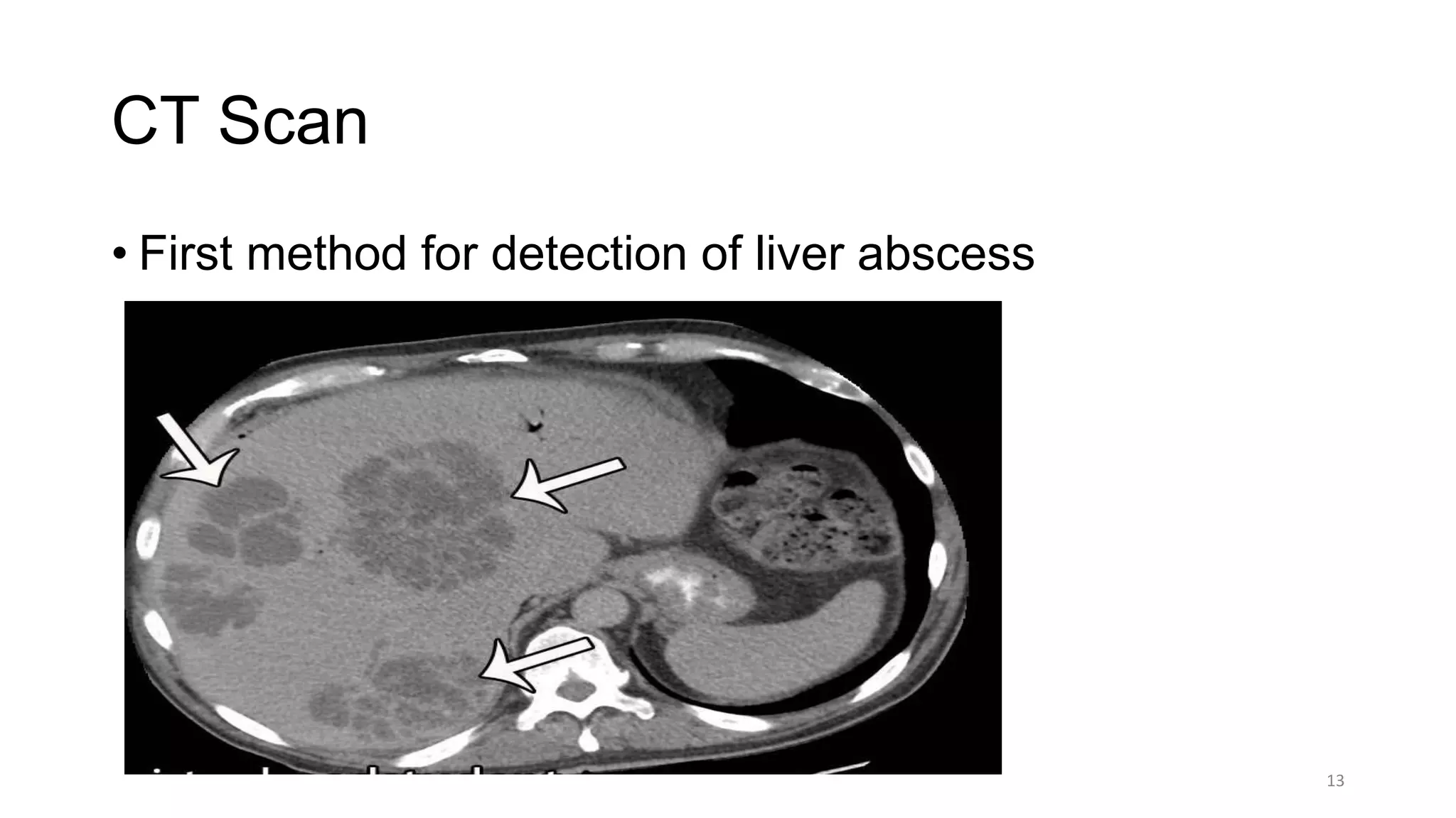 Liver abscess.pptx