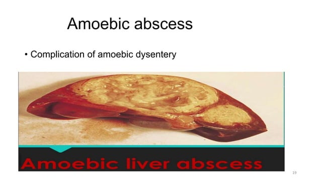 Liver abscess.pptx