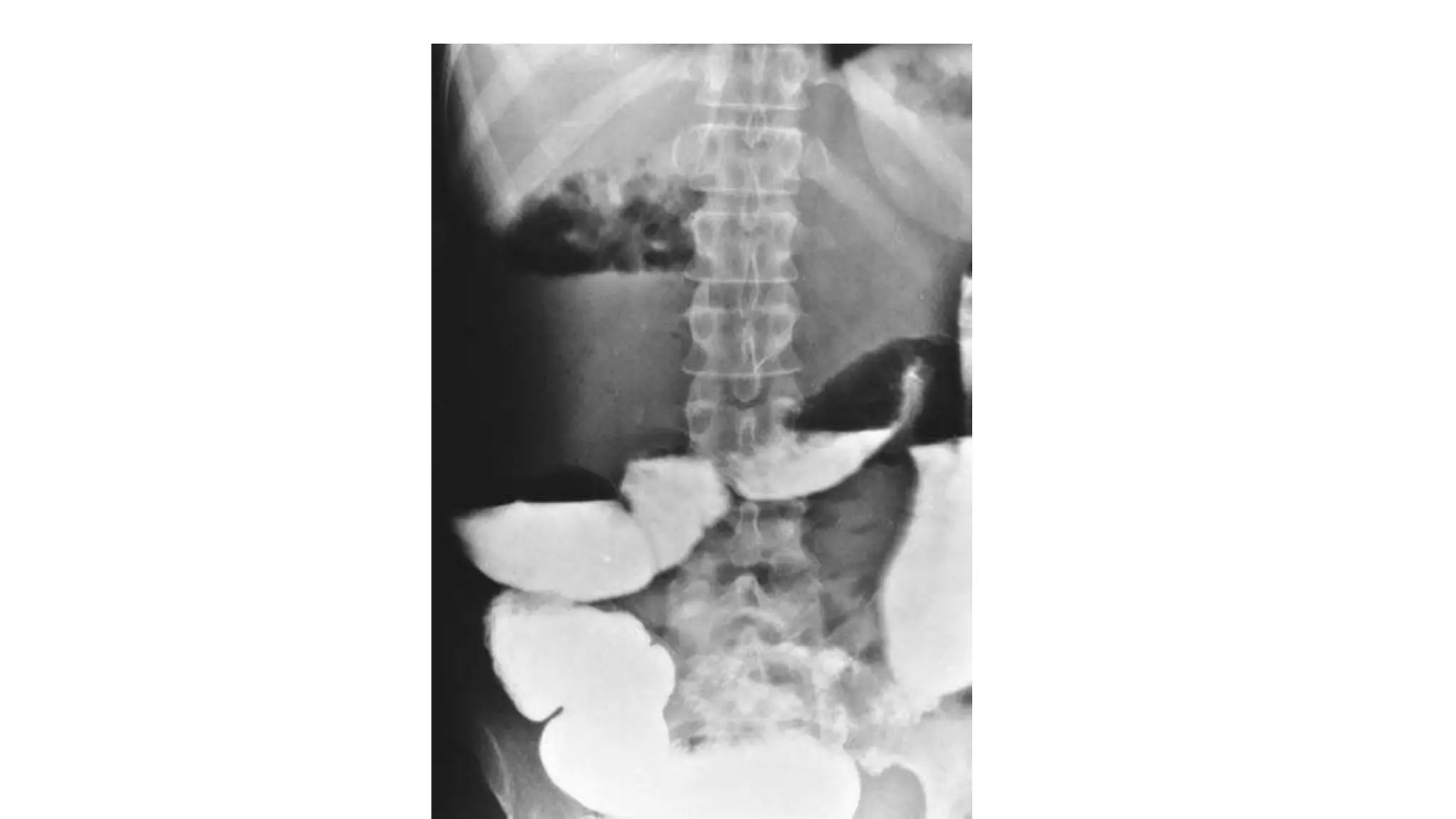 Liver Abscess Pptx