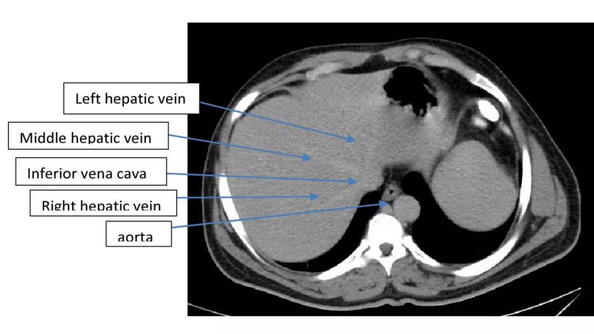 Liver abscess .pptx | Blood Disorders | Diseases and Conditions
