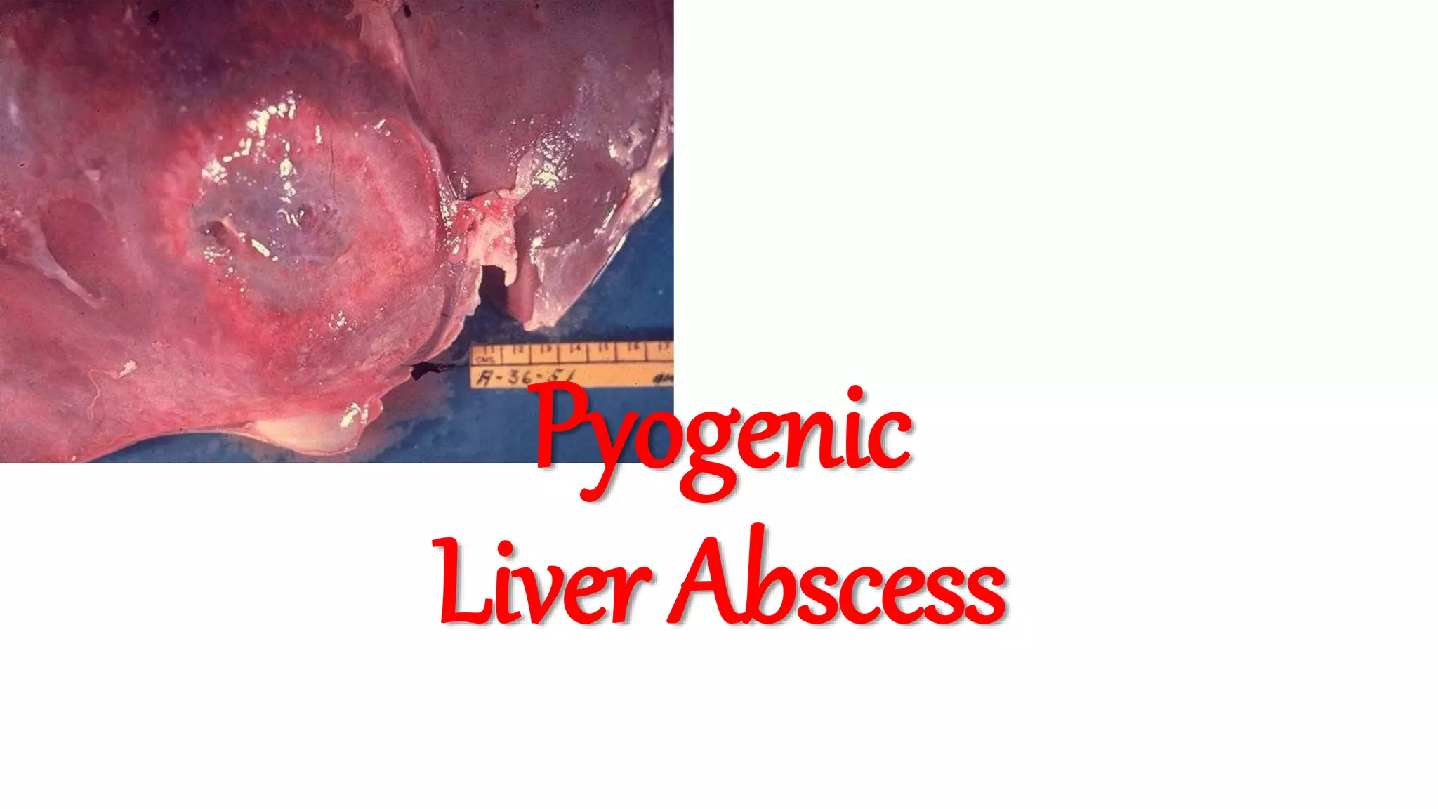 Liver abscess .pptx | Blood Disorders | Diseases and Conditions