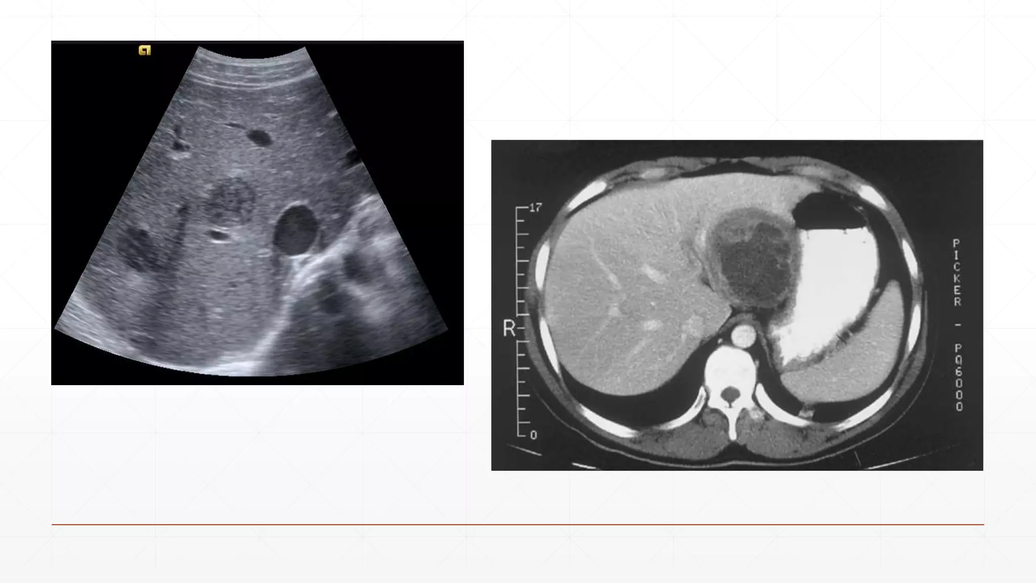 Liver Abscess.pptx