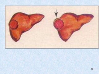 Liver Abscess.ppt