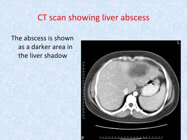 Liver Abscess.ppt