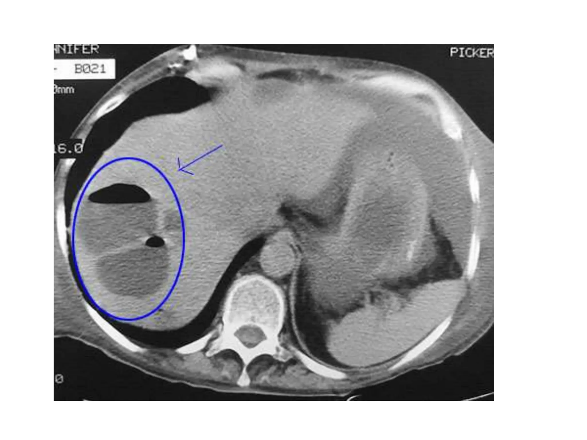 Liver Abscess and its management modalities.pptx