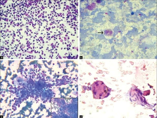 Liver Abscess and its management modalities.pptx