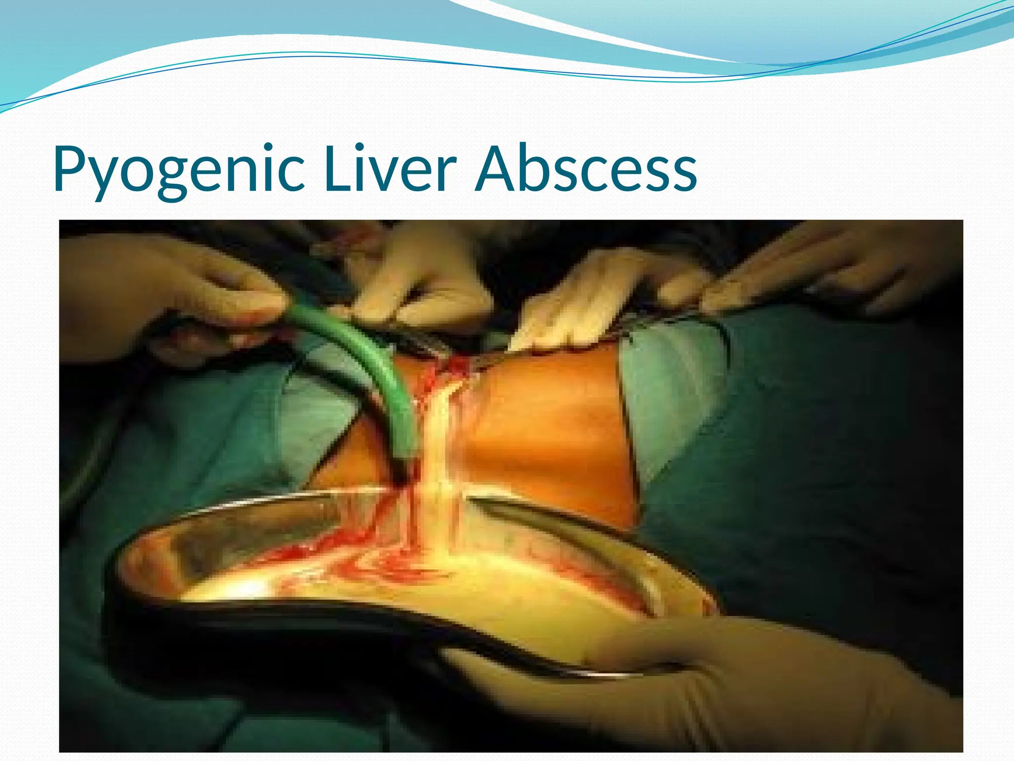 LIVER ABSCESS- introduction, definition, types, causes, sign and symptoms, diagnostic evaluation ...