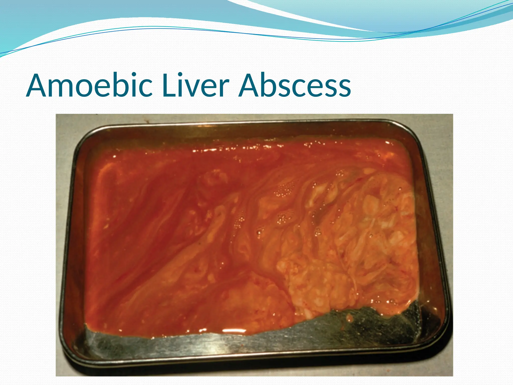 LIVER ABSCESS- introduction, definition, types, causes, sign and ...