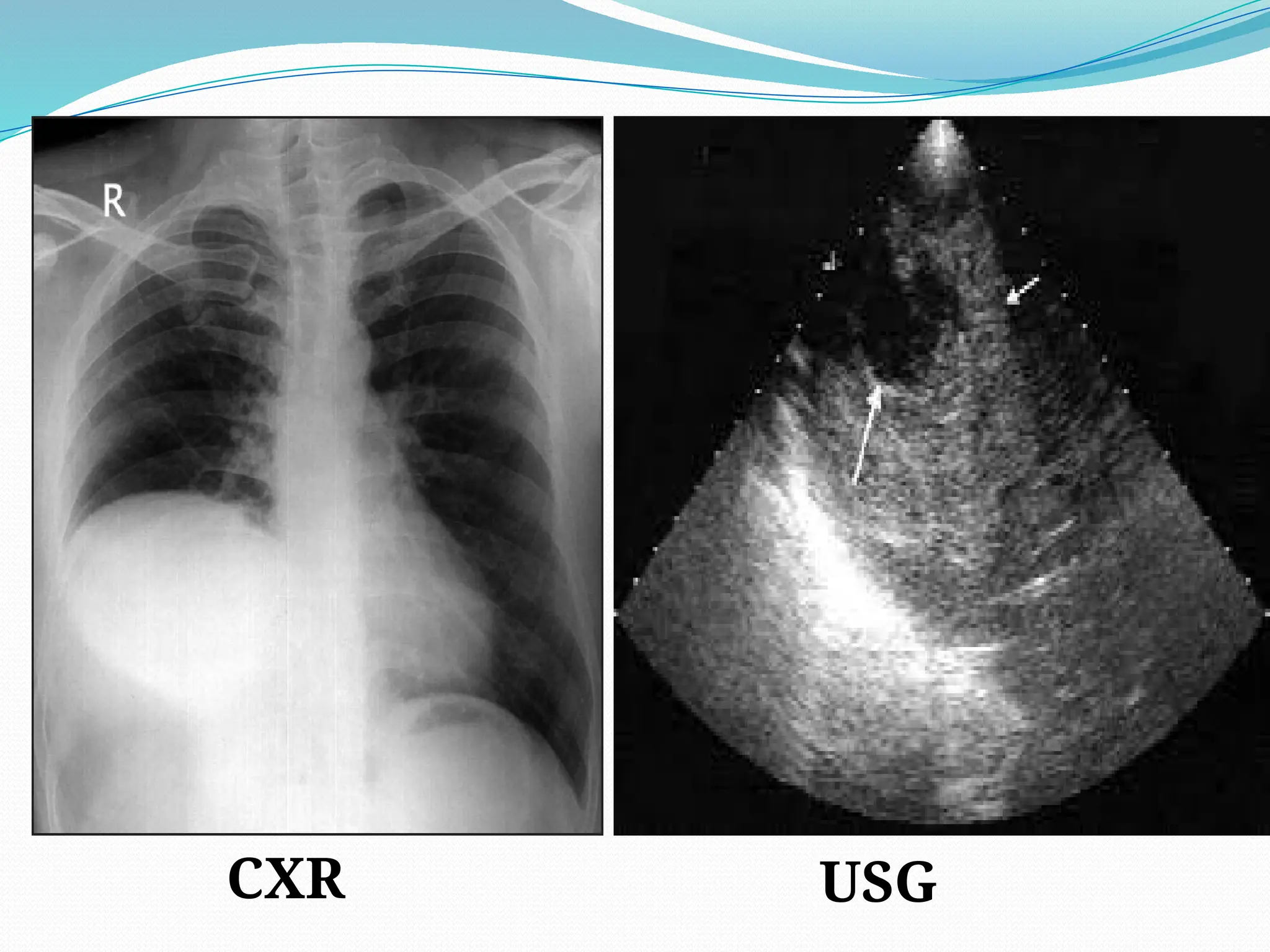 LIVER ABSCESS- introduction, definition, types, causes, sign and ...