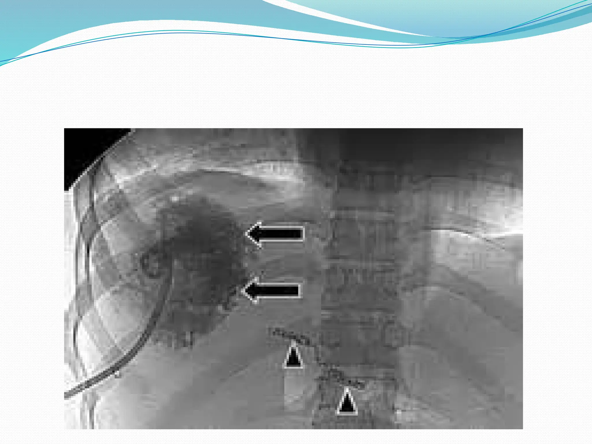 LIVER ABSCESS- introduction, definition, types, causes, sign and ...