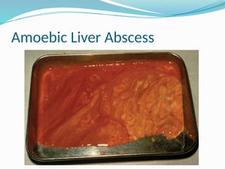 LIVER ABSCESS- introduction, definition, types, causes, sign and ...