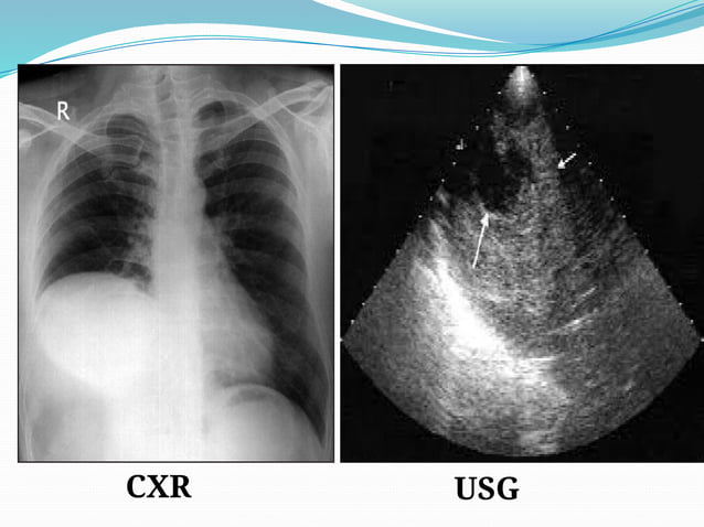 LIVER ABSCESS- introduction, definition, types, causes, sign and ...