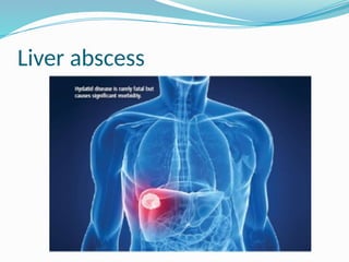 LIVER ABSCESS- introduction, definition, types, causes, sign and ...