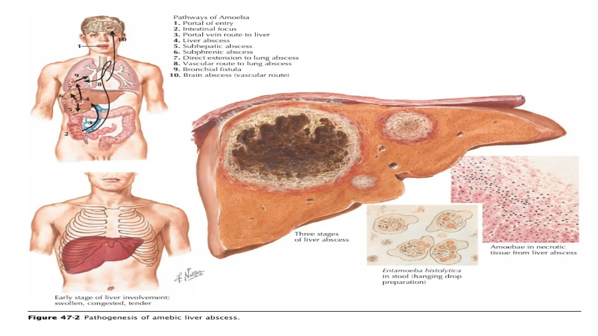 Liver Abscess.pptx surgical site infenctions | PPTX