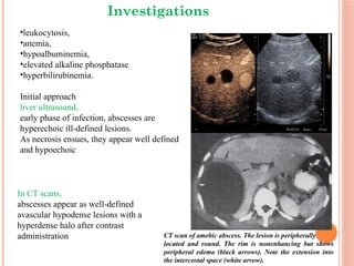 Liver abscess. Briefly explained including new techniques of management ...