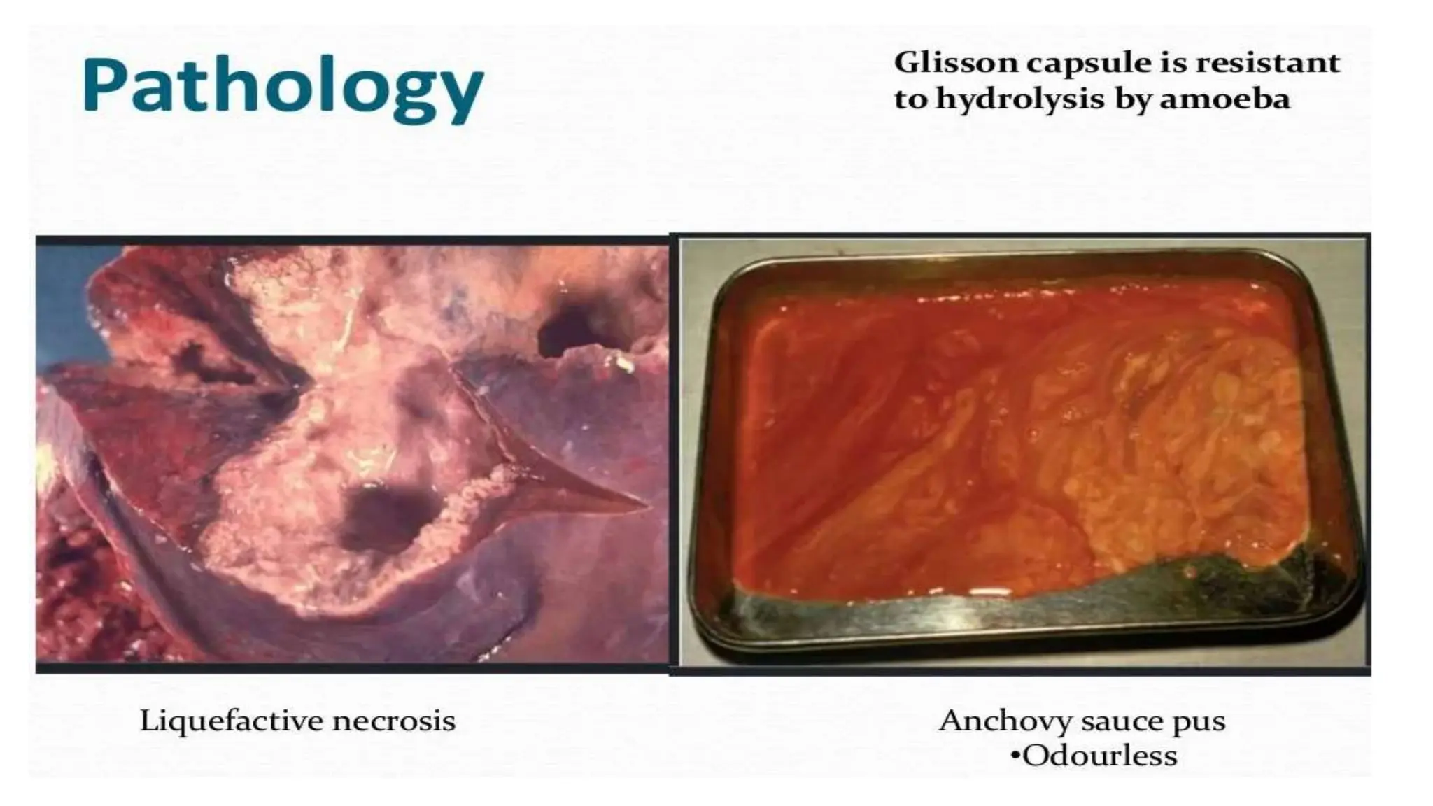 Liver Abscess by Dr Mudassir Baig PIMS.pptx
