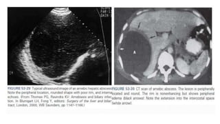 Liver Abscess by Dr Mudassir Baig PIMS.pptx
