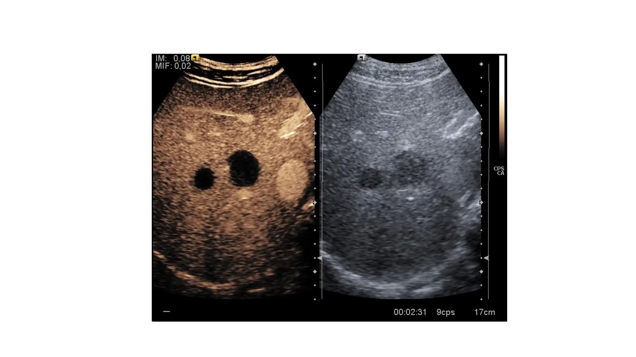 Liver abscess (Diagnosis and management).pdf