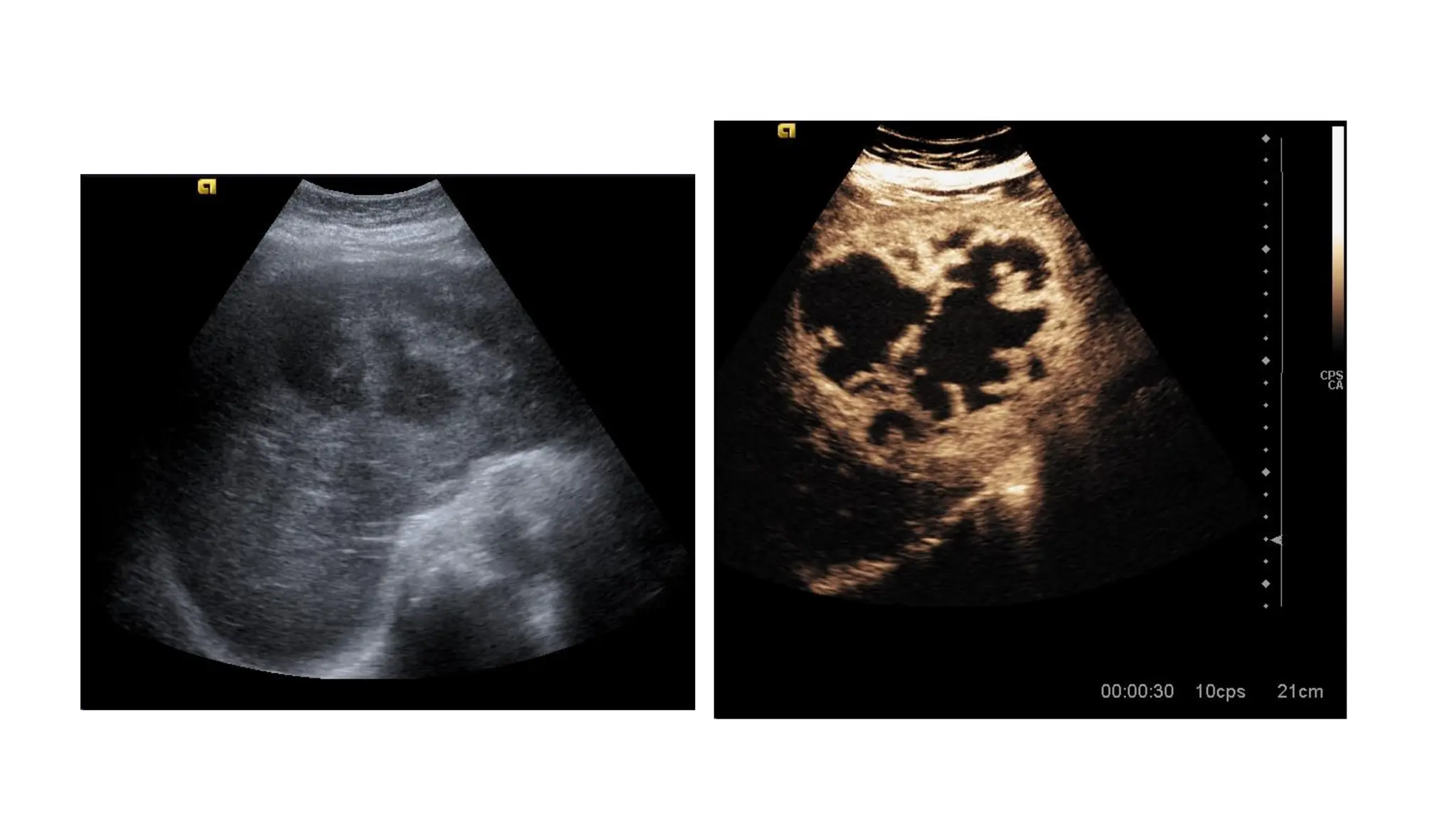 Liver abscess (Diagnosis and management).pdf
