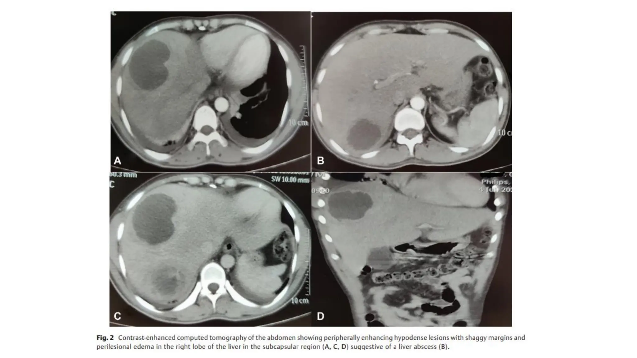 Liver abscess (Diagnosis and management).pdf
