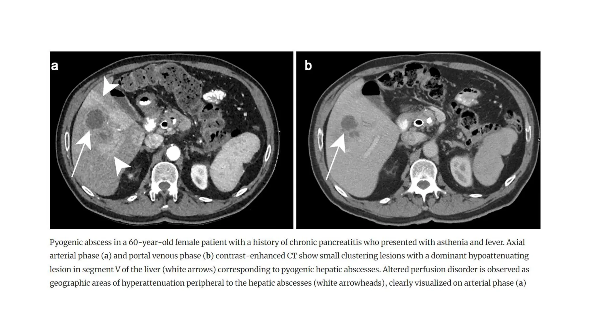 Liver abscess (Diagnosis and management).pdf