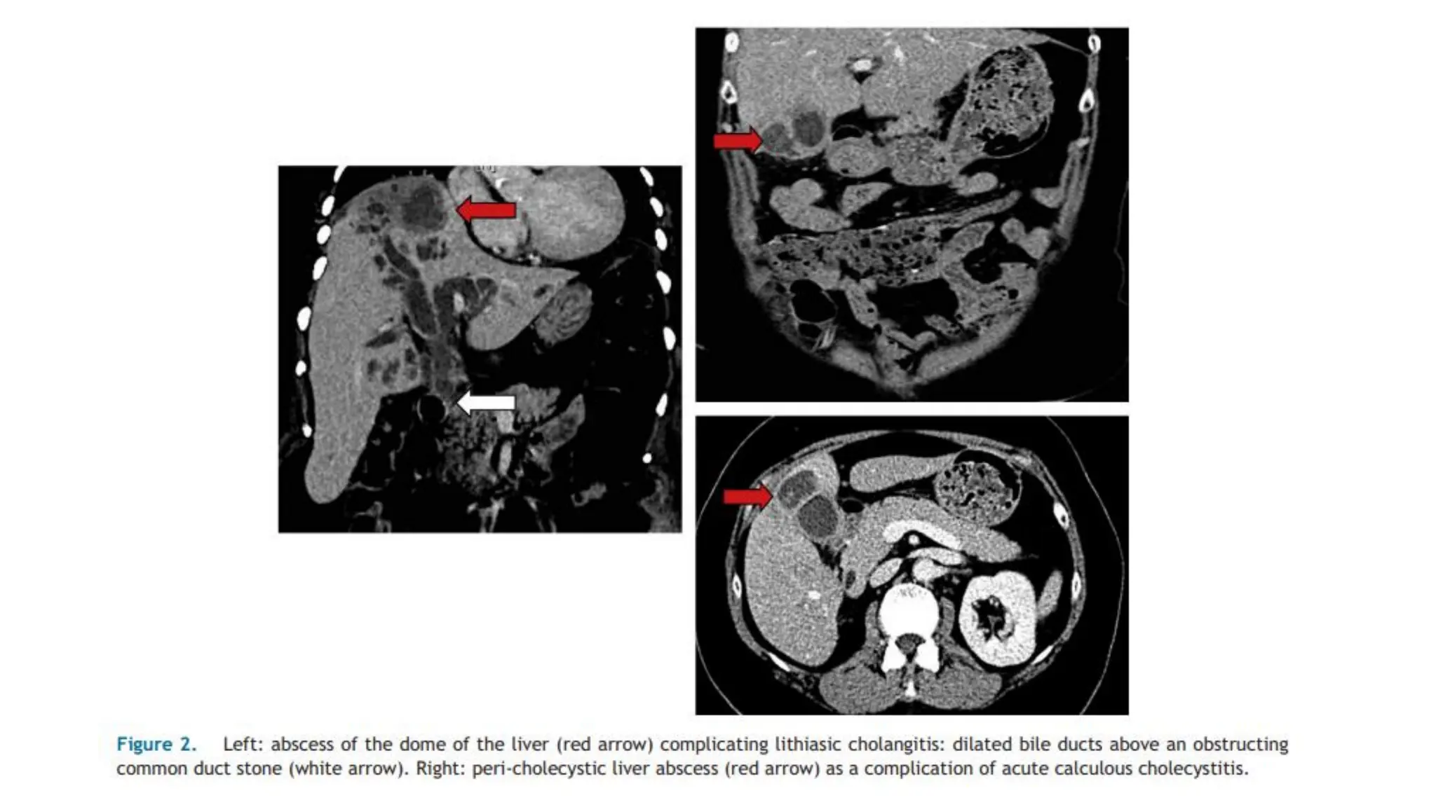 Liver abscess (Diagnosis and management).pdf