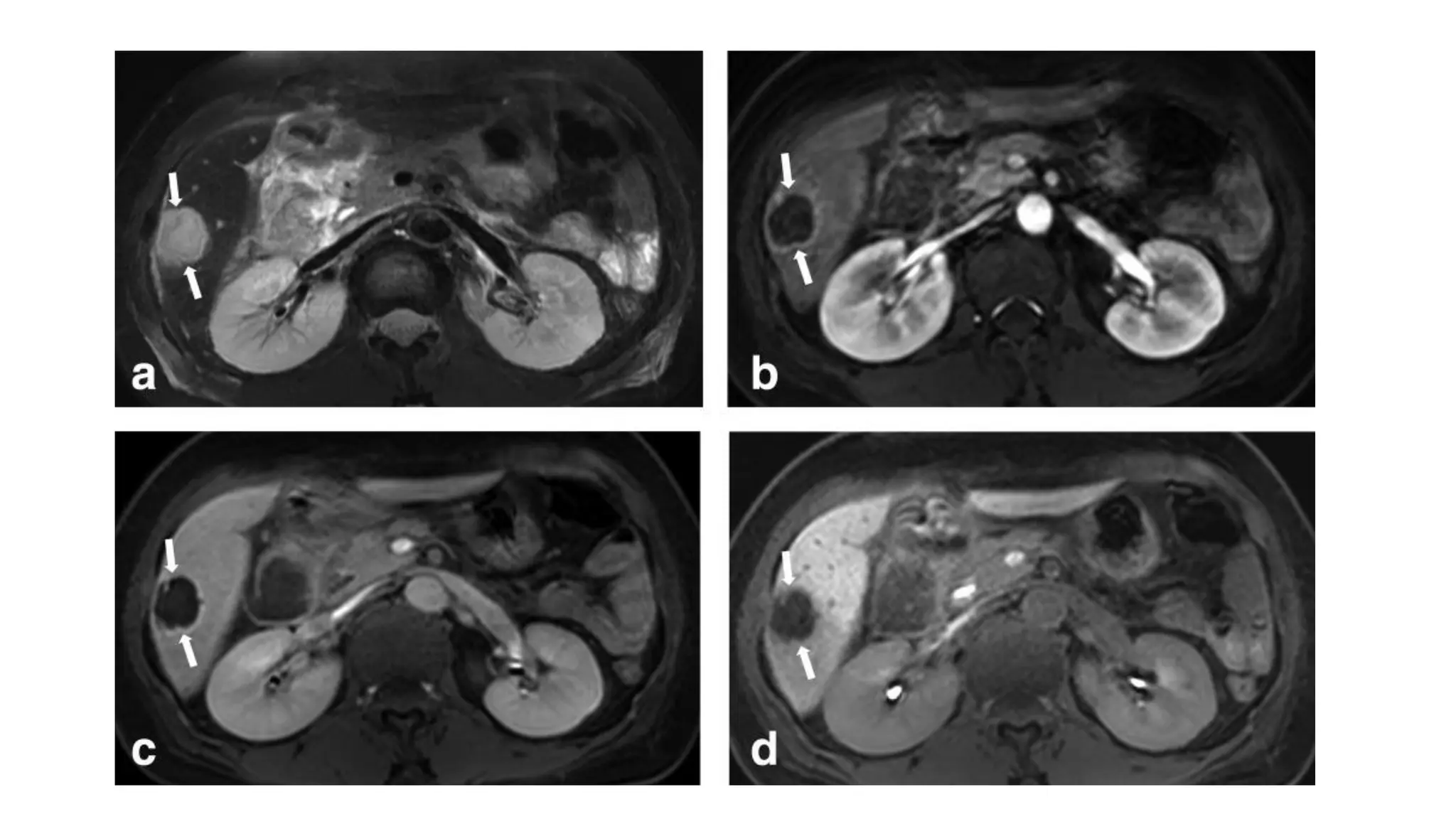 Liver abscess (Diagnosis and management).pdf