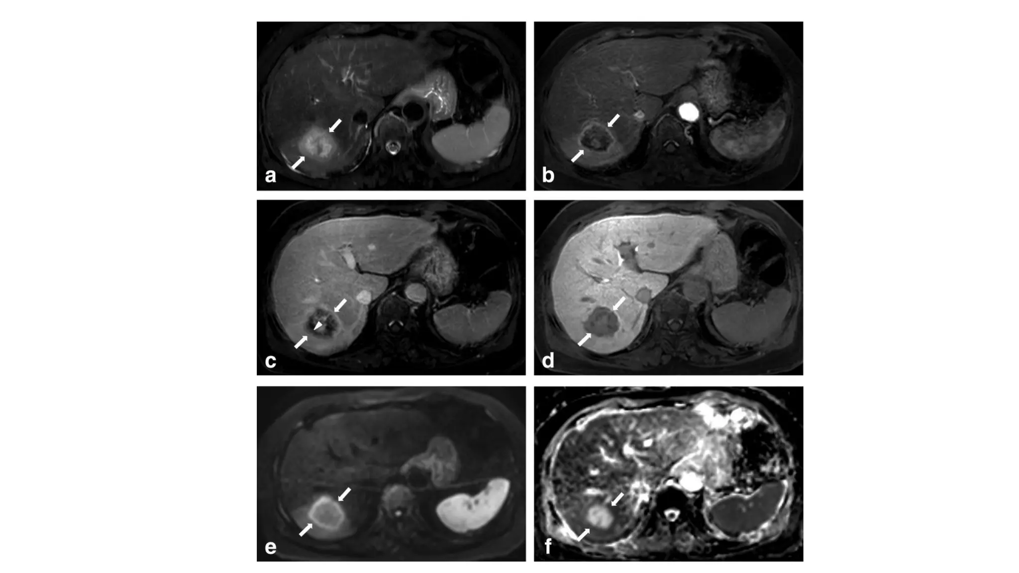 Liver abscess (Diagnosis and management).pdf