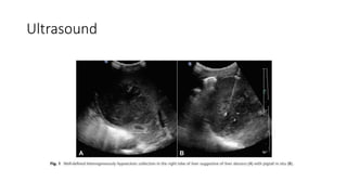Liver abscess (Diagnosis and management).pdf