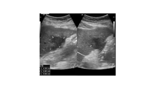 Liver abscess (Diagnosis and management).pdf