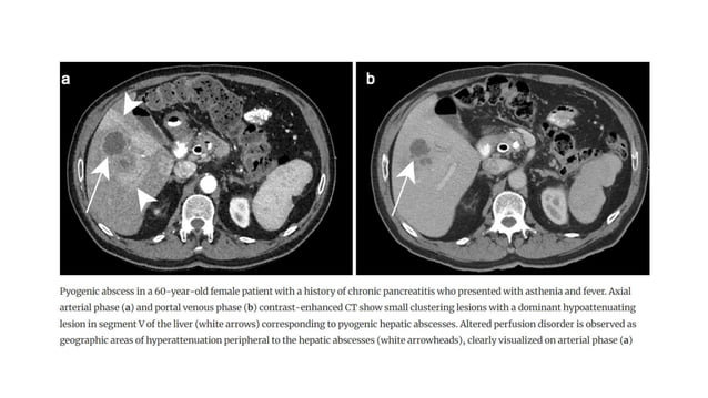 Liver abscess (Diagnosis and management).pdf