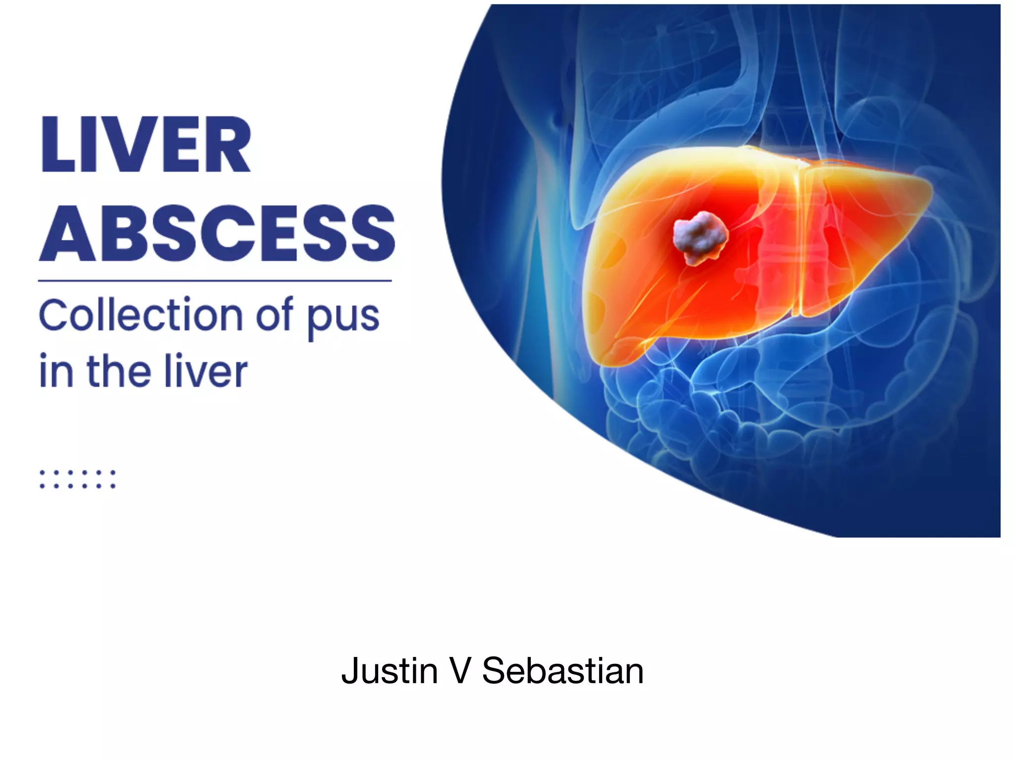 Liver Abscesses.pdf