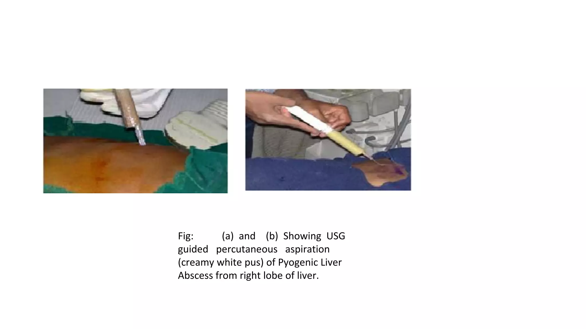 Liver Abscess ppt.pptx | Lung and Respiratory Health | Diseases and ...