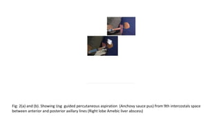 Liver Abscess ppt.pptx
