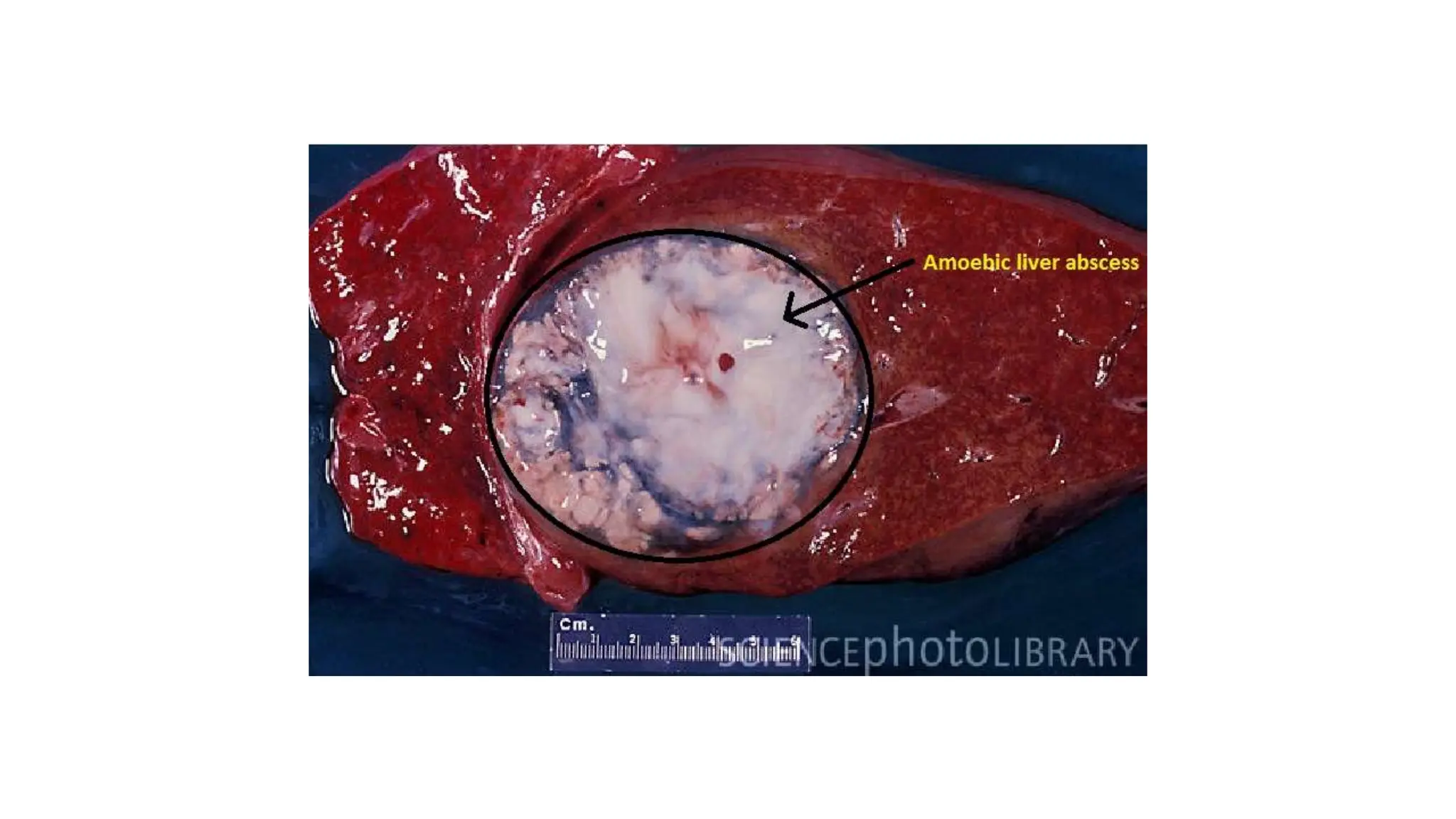 LIVER ABSCESS ppt.pptx