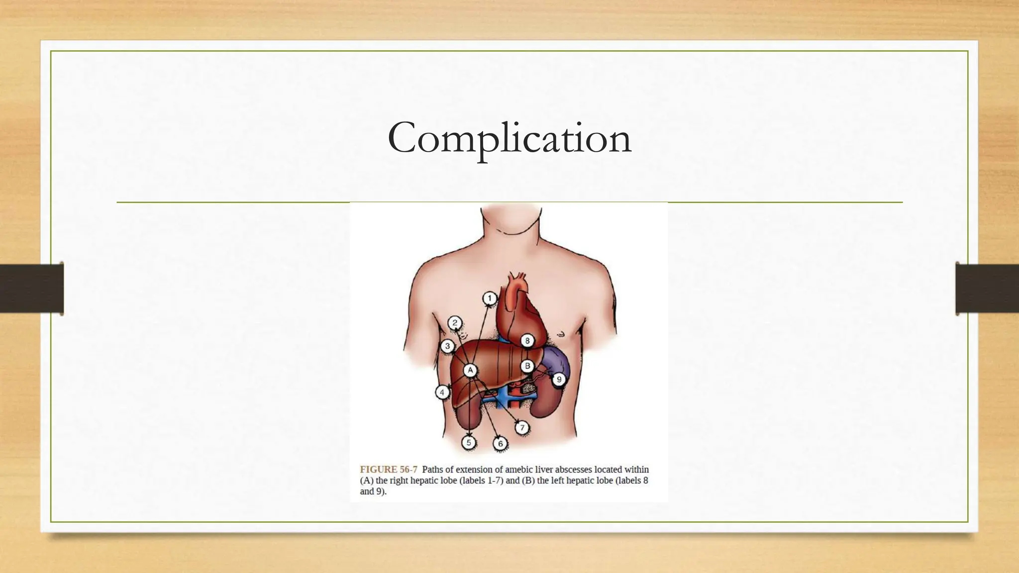 Liver Abscess | Surgery Department .pptx