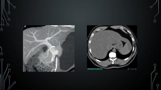 Liver and biliary tract - Normal anatomy and Imaging techniques.pptx