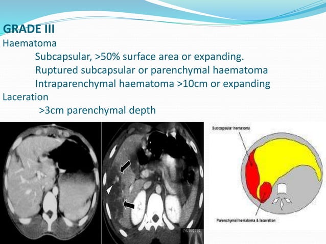 LIVER AND SPLEEN TRAUMA.pptx