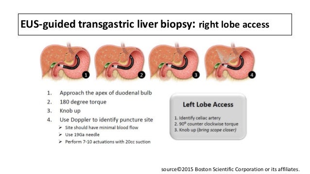 Liver Biopsy Procedure